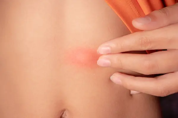 Identify Ant Bites | Bug Out NC